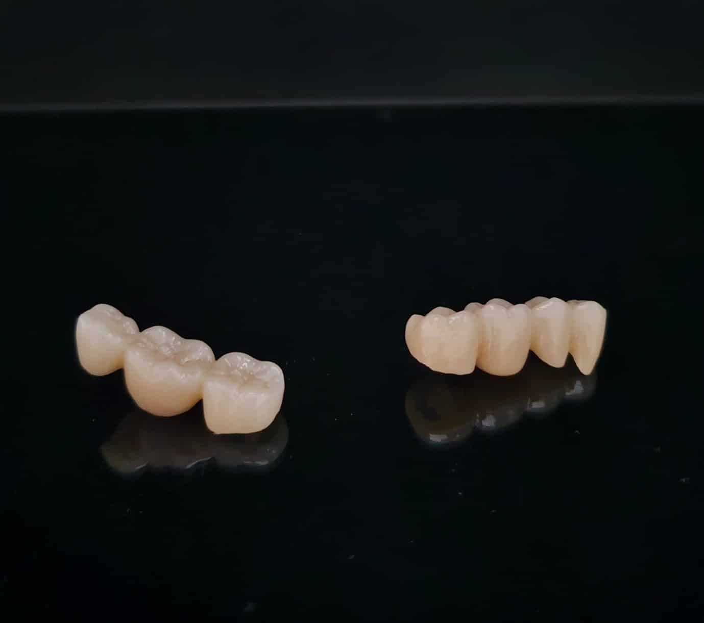Zirconia and Porcelain Fixed Bridges - Dental Express México